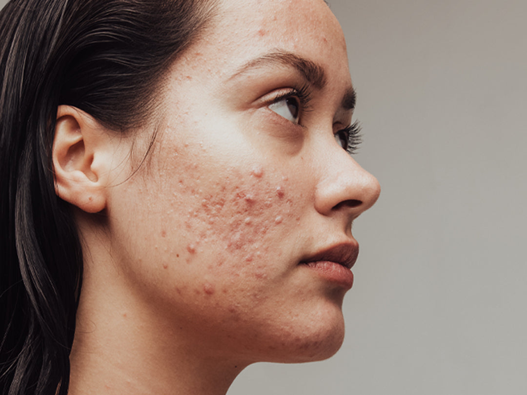 Types of Acne: Mild, Moderate & Severe – Cantabria Labs