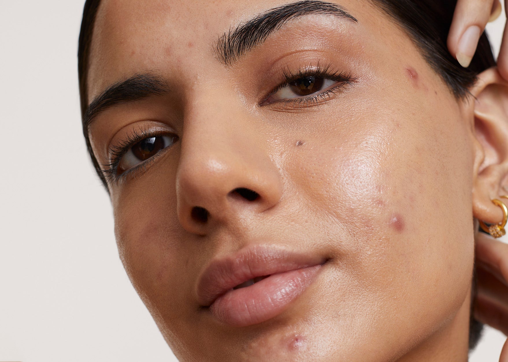Spot/Acne Prone Skin – Cantabria Labs