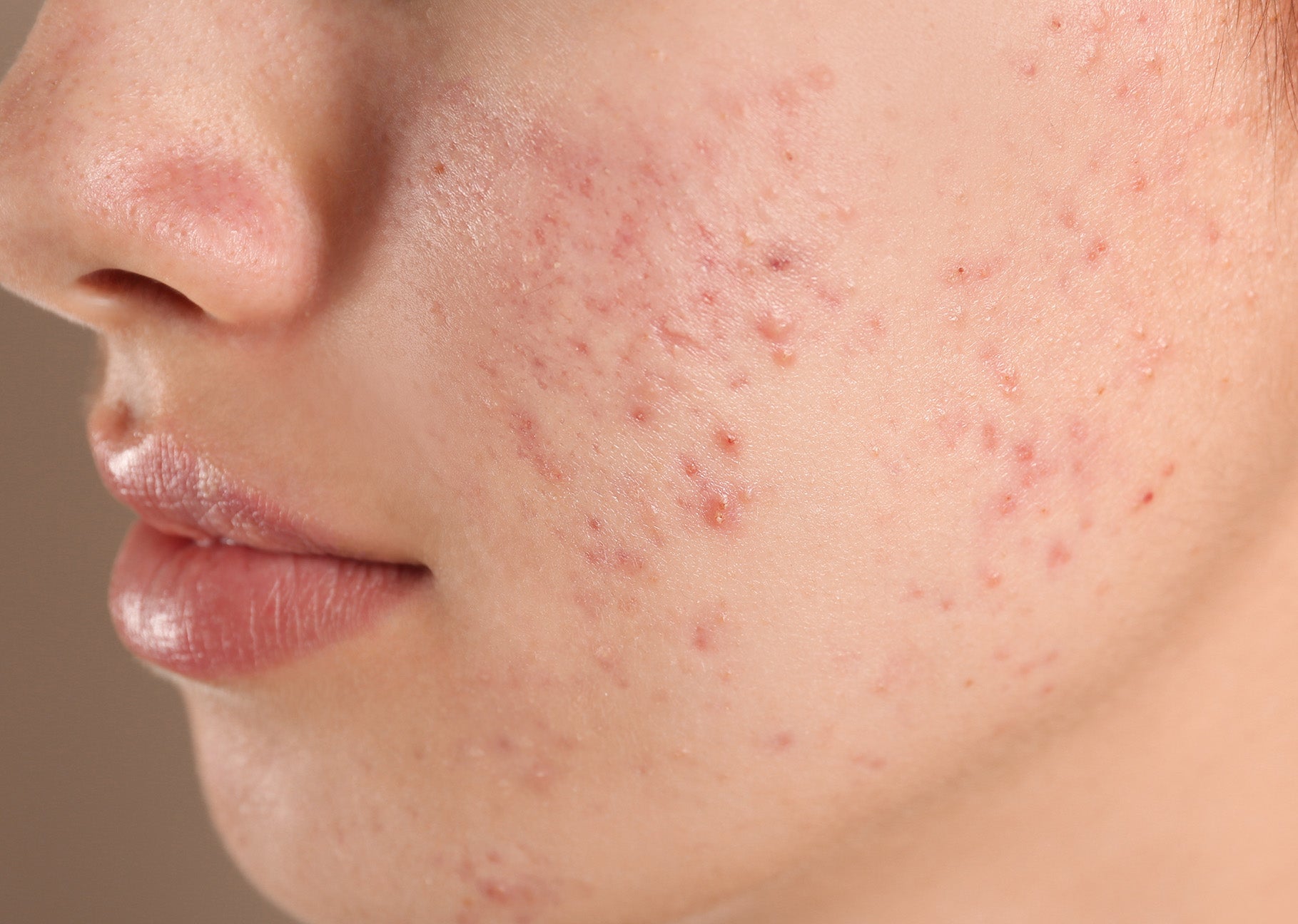 Spot/Acne Prone Skin – Cantabria Labs