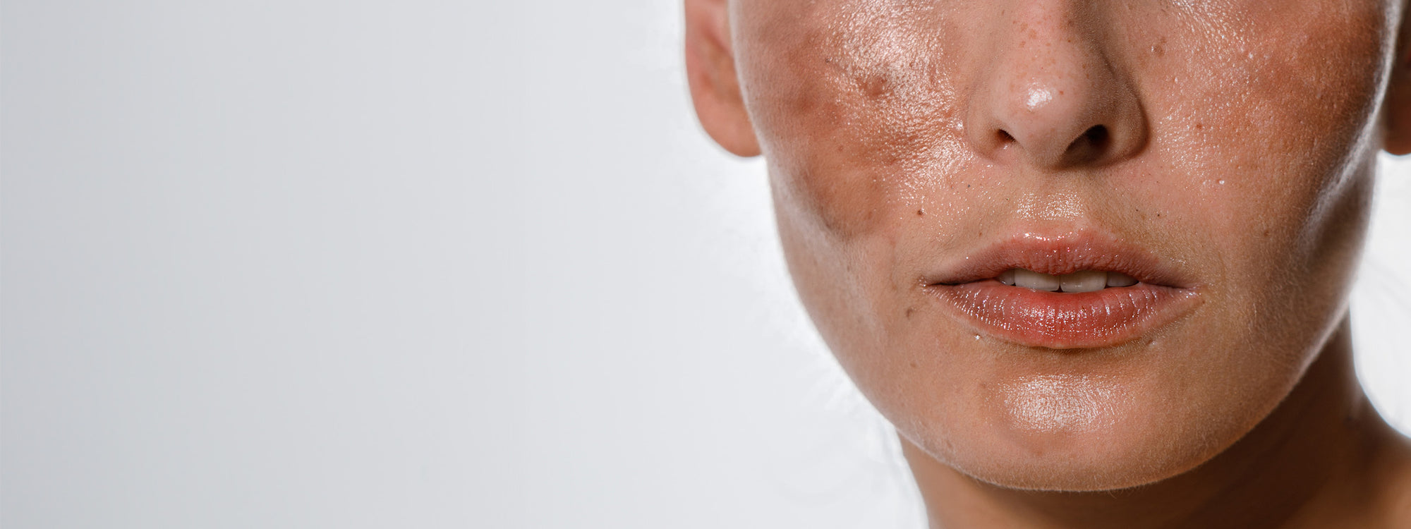Hyperpigmentation – Cantabria Labs